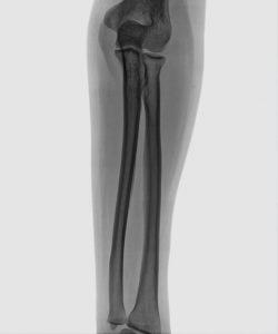 Bone Densitometry | Léger Radiologie